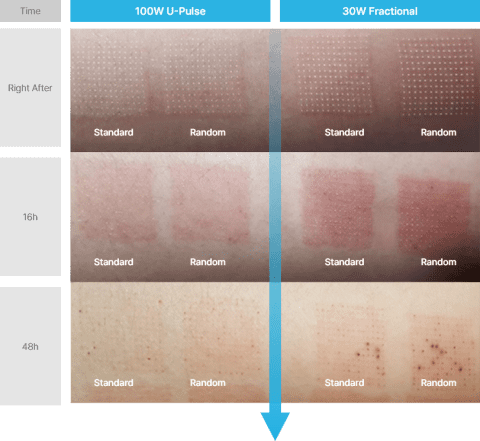 U-Pulse Fractional CO2 Laser | skin resurfacing - SNJ